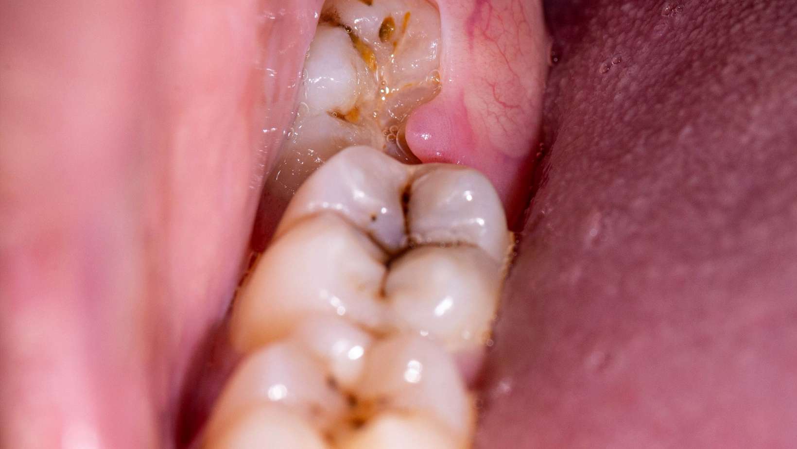 10 Red Flags for Wisdom Teeth Removal | Dr Vikram Pandit, Pune