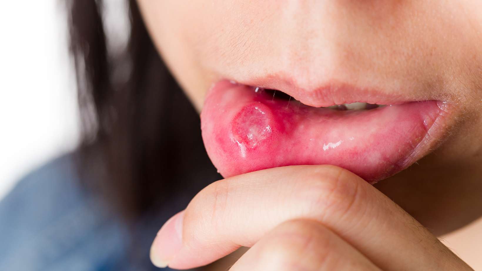 Oral Ulcers in Children: Causes, Symptoms & Treatment Options